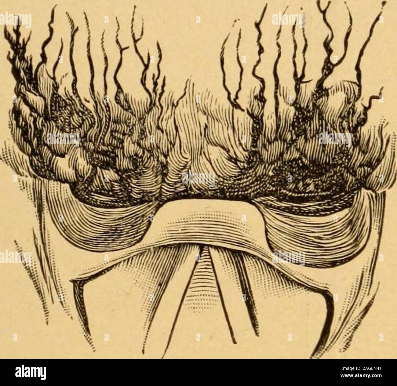 Lingual Varicosities Cause