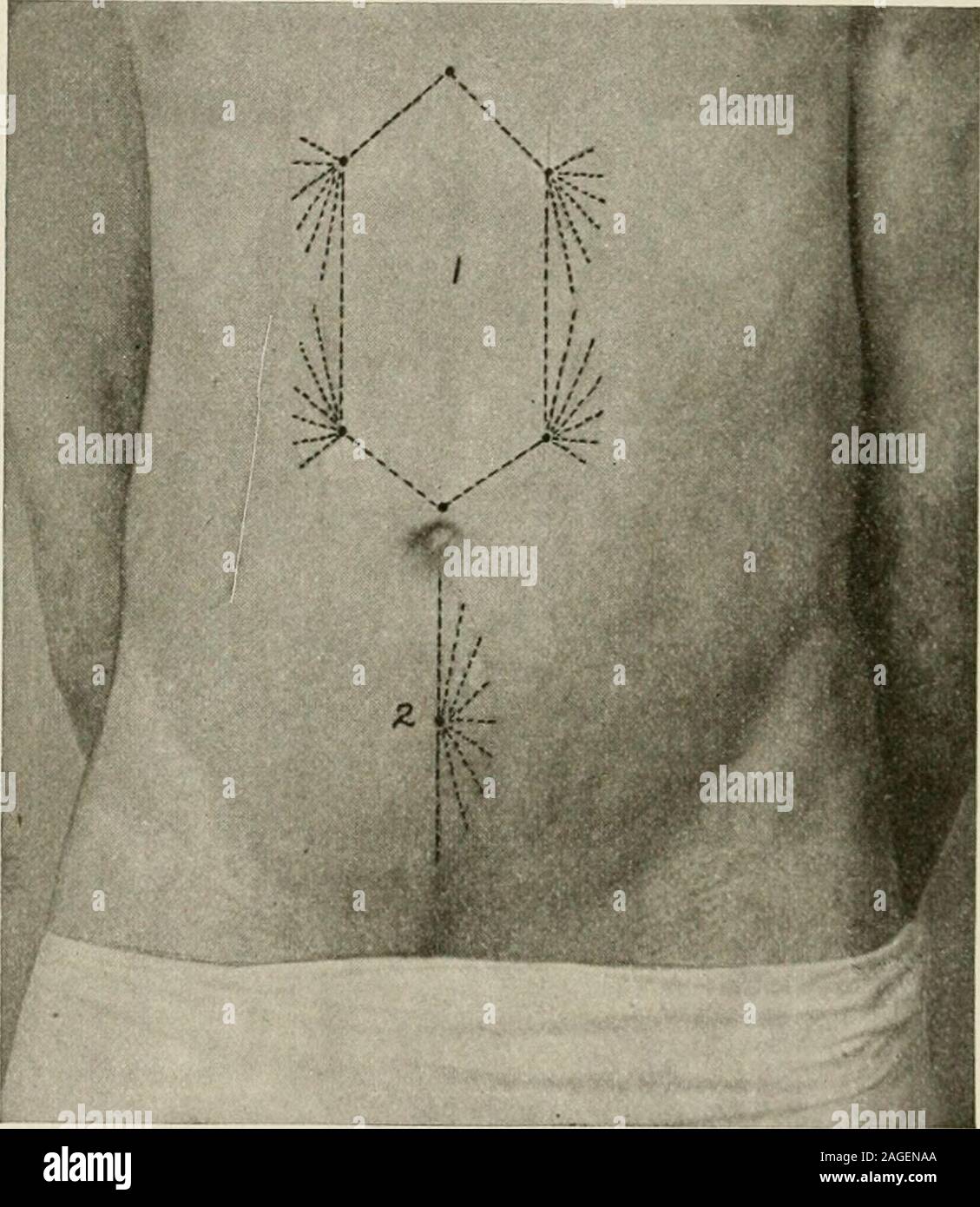 . Local and regional anesthesia; with chapters on spinal, epidural ...