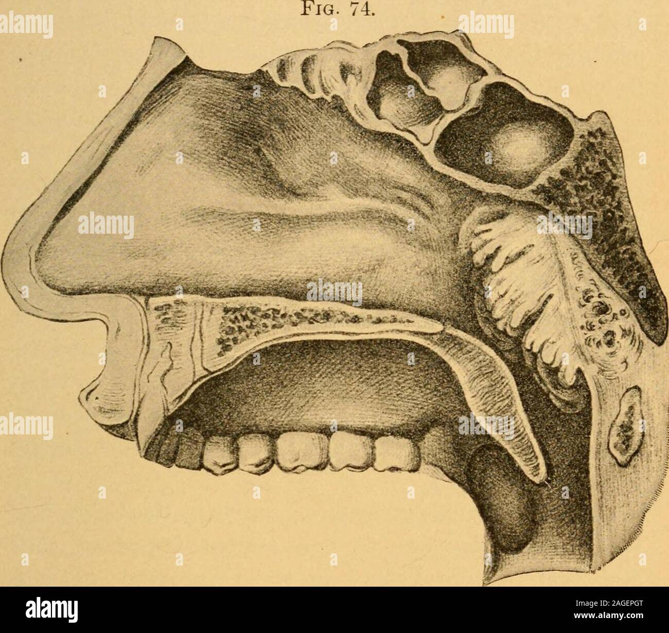 Lymphoid hypertrophy hi-res stock photography and images - Alamy