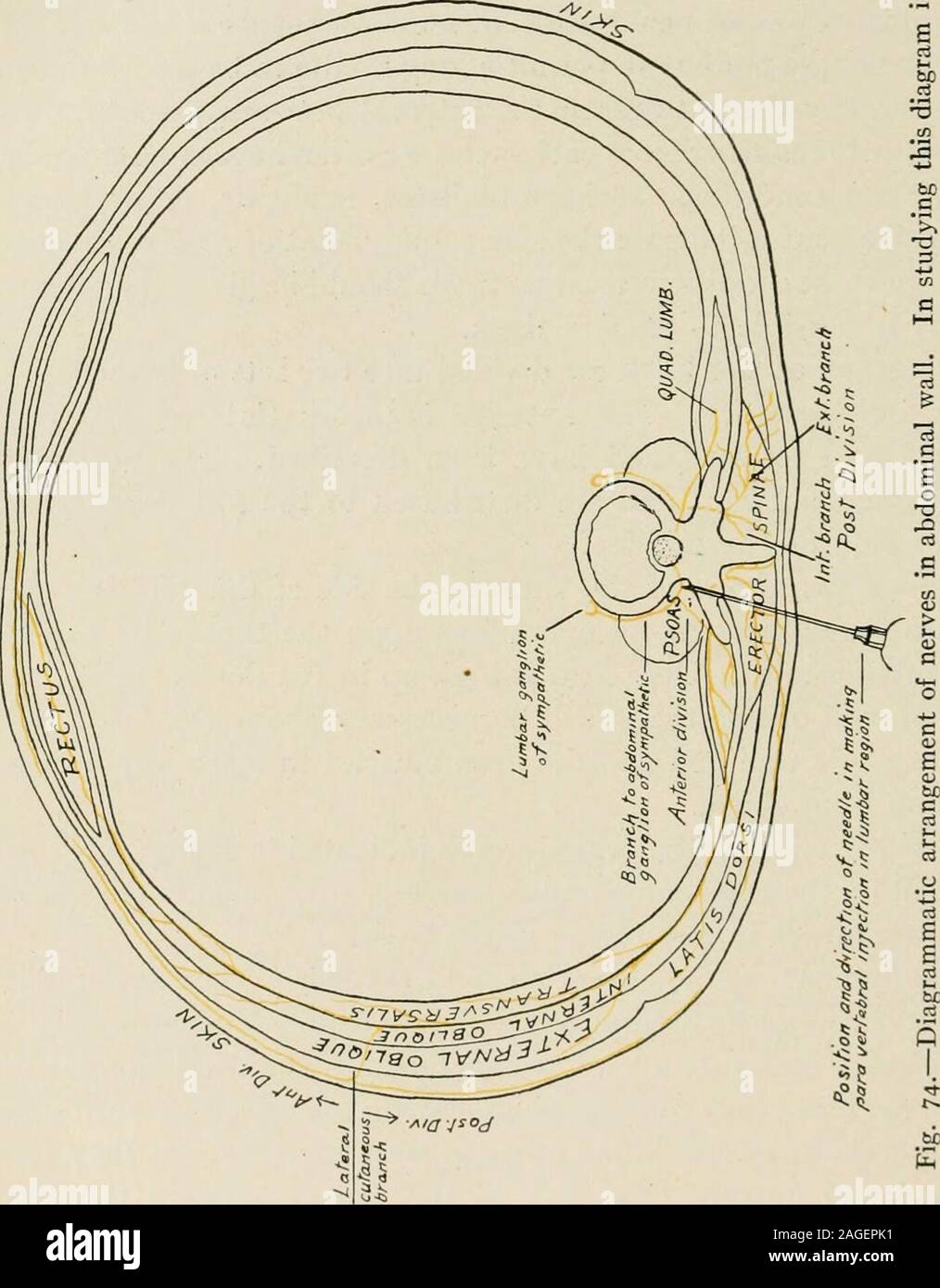 . Local and regional anesthesia; with chapters on spinal, epidural ...