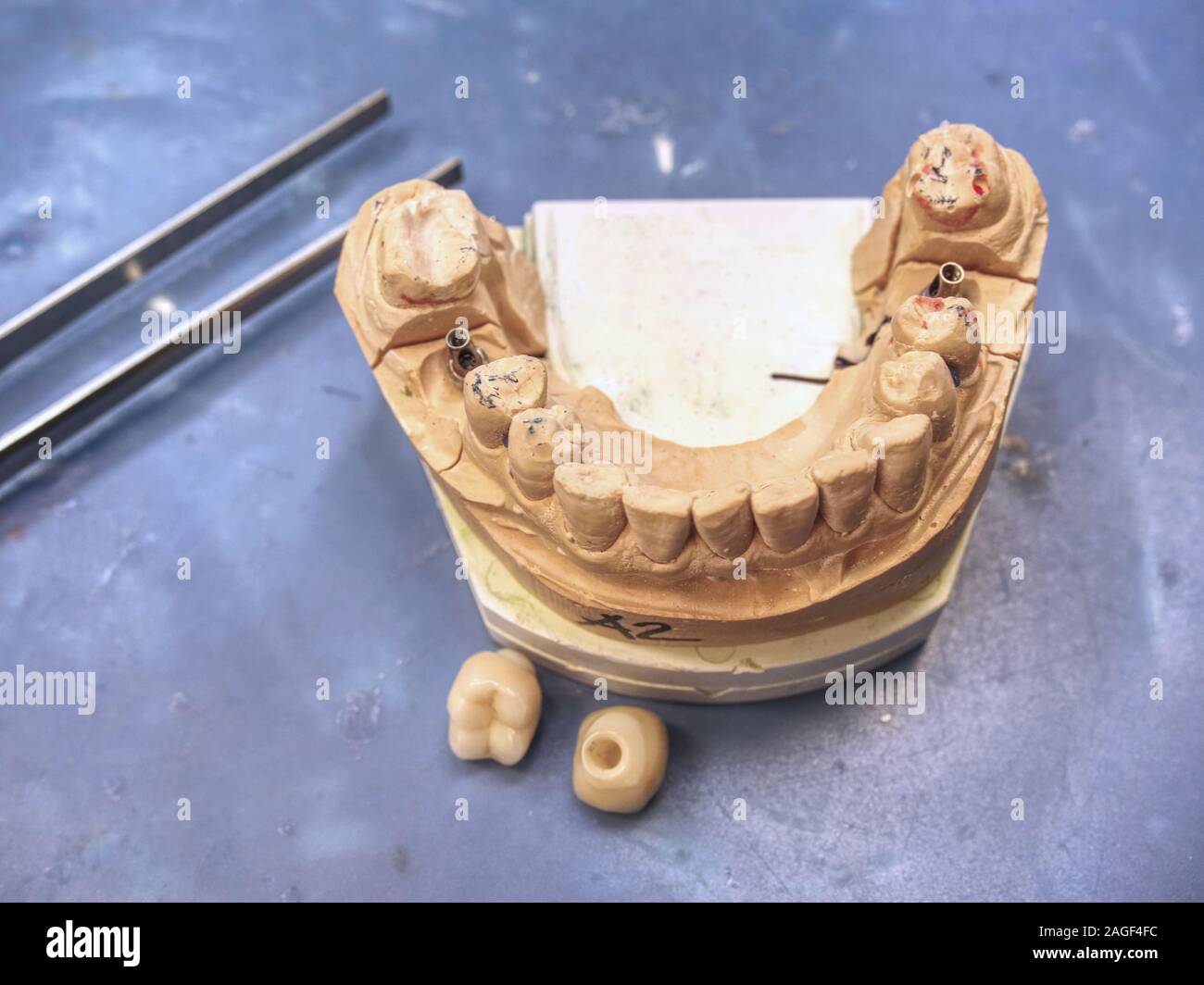 metal cast pin of tooth on a 3D model in laboratory. Sharpened and ...