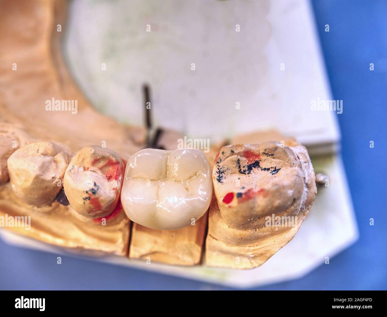 Jaw plaster cast with fixed dentures in dental Prothetic laboratory ...