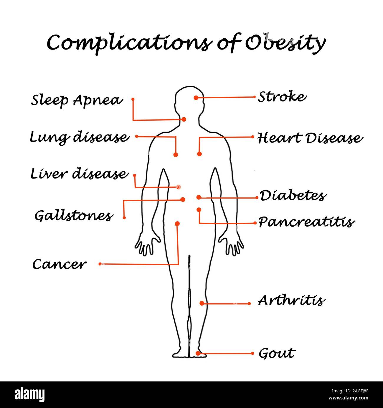 Complications of Obesity Stock Photo - Alamy