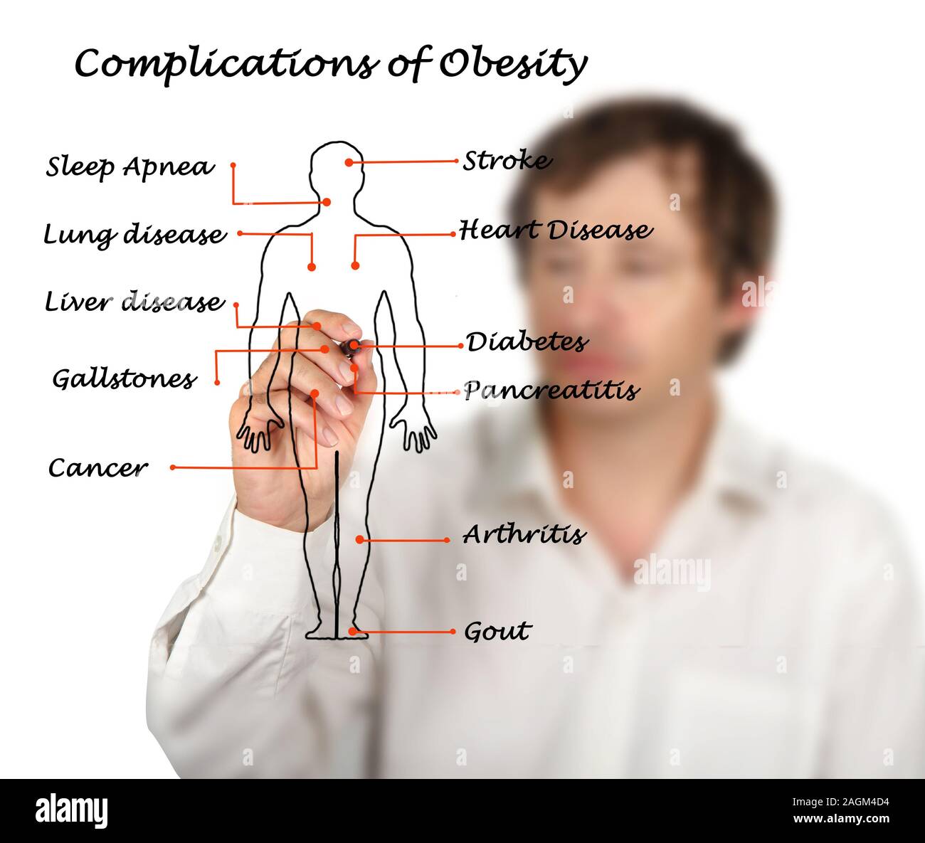Obesity complications hi-res stock photography and images - Alamy
