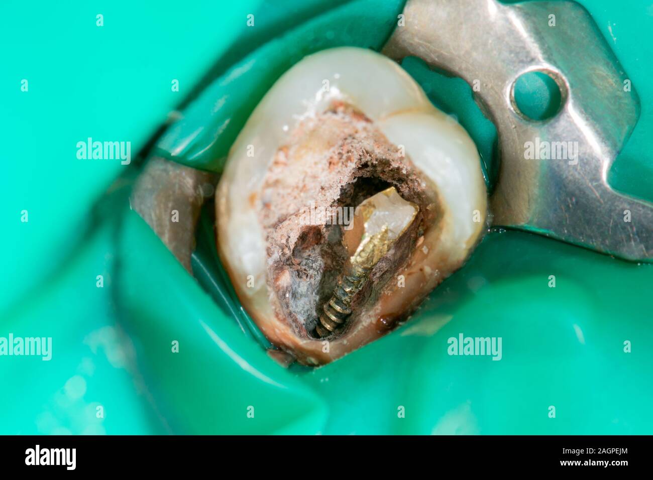 human tooth close-up macro. Endodontics treatment of canals and pulp of ...