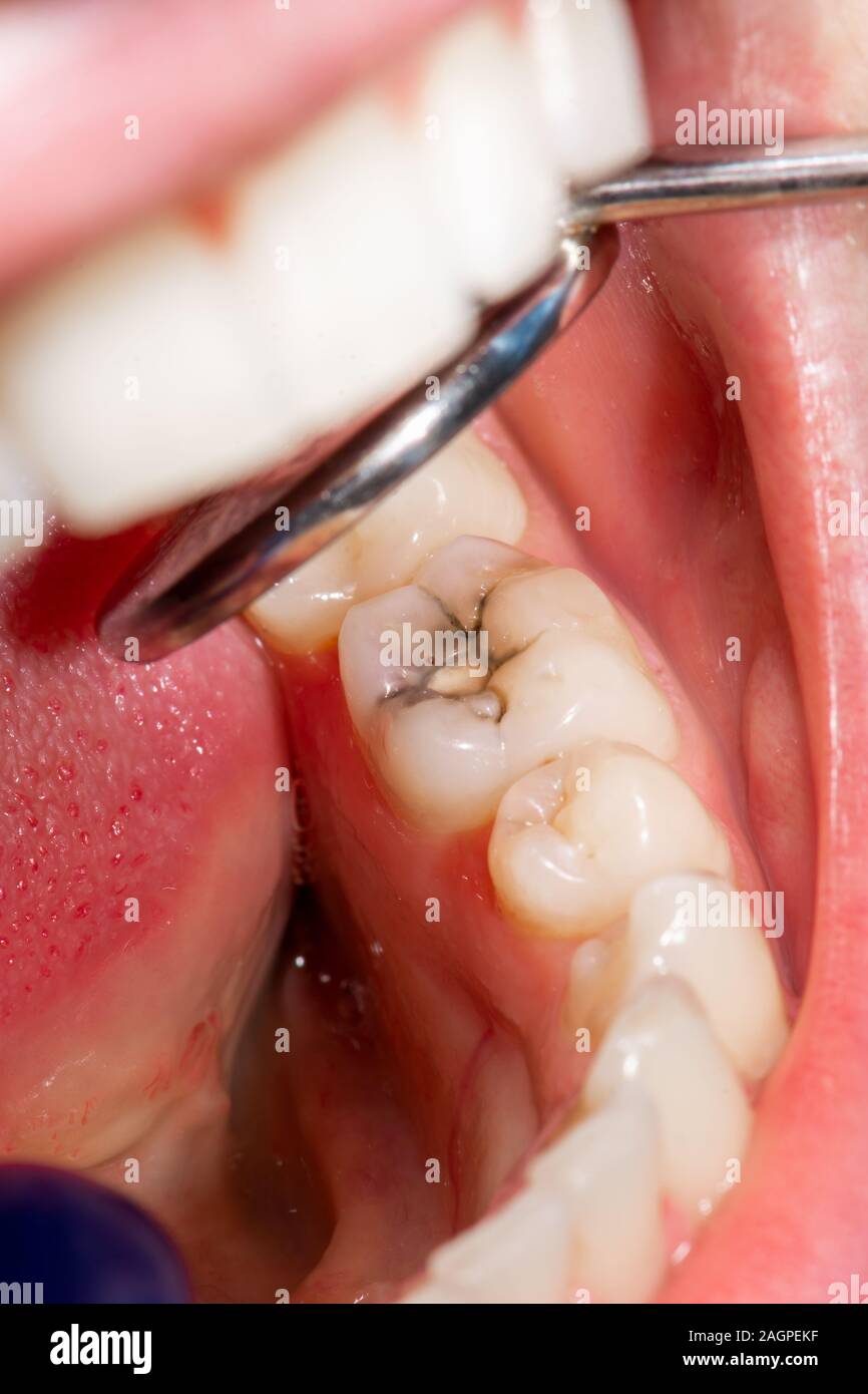 restoration of tooth with photopolymer filling close-up macro. Caries ...