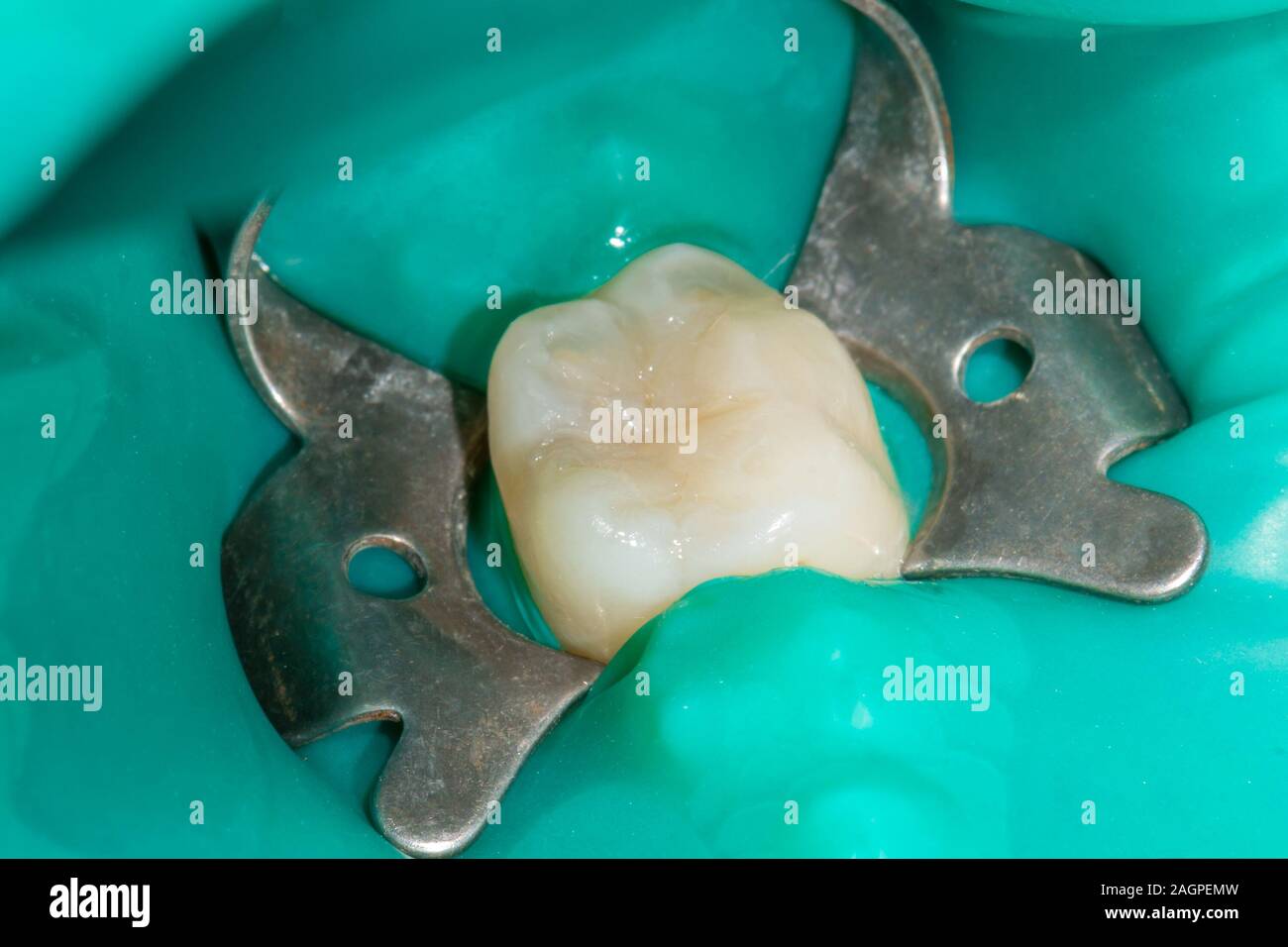 restoration of tooth with photopolymer filling close-up macro. Caries ...