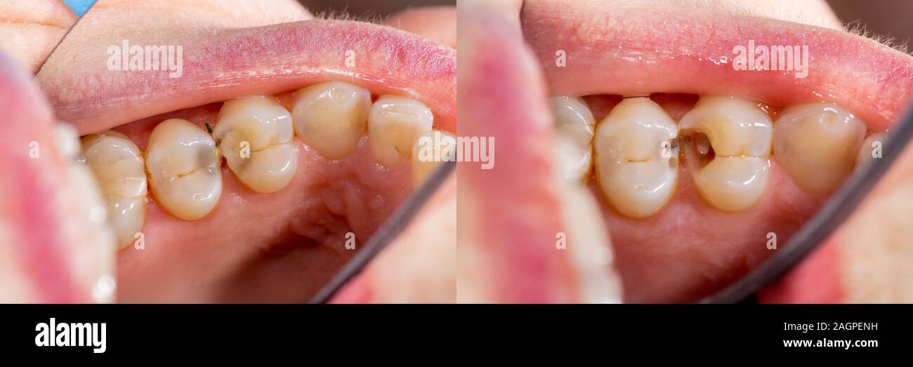 two chewing side teeth of the upper jaw after treatment of caries ...