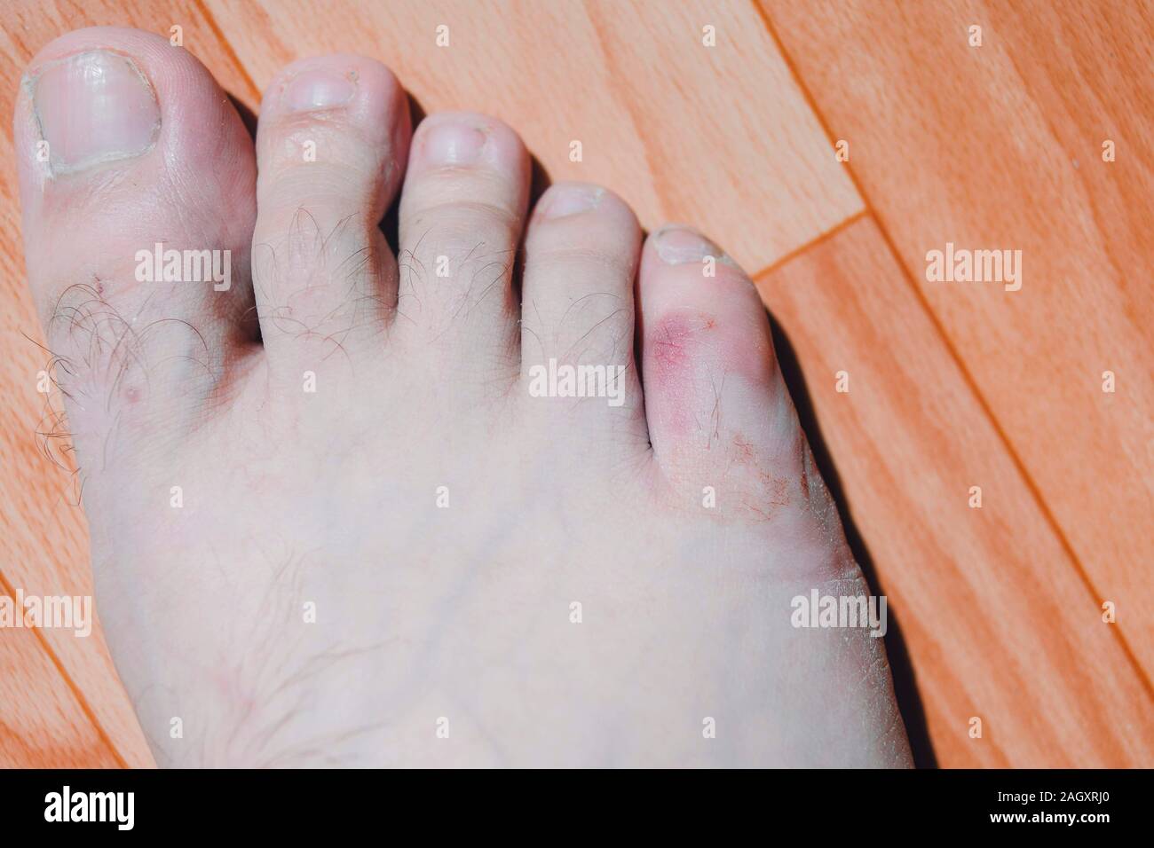 Broken leg. Patient with broken leg for treatment in the hospital Stock ...