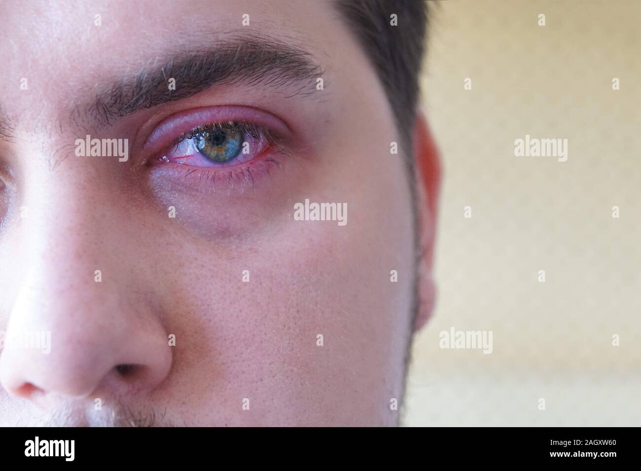 Chalazion Abscess High Resolution Stock Photography and Images - Alamy