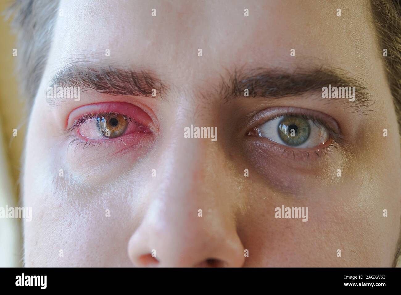 Two red eyes of man is watching to the camera. One right eye eyelid ...