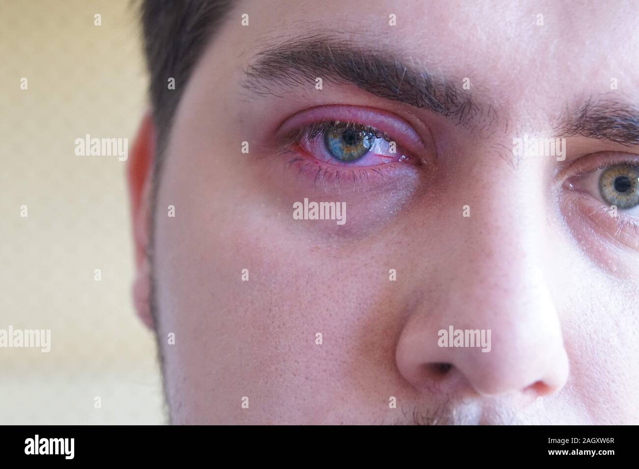 Chalazion Abscess High Resolution Stock Photography and Images - Alamy