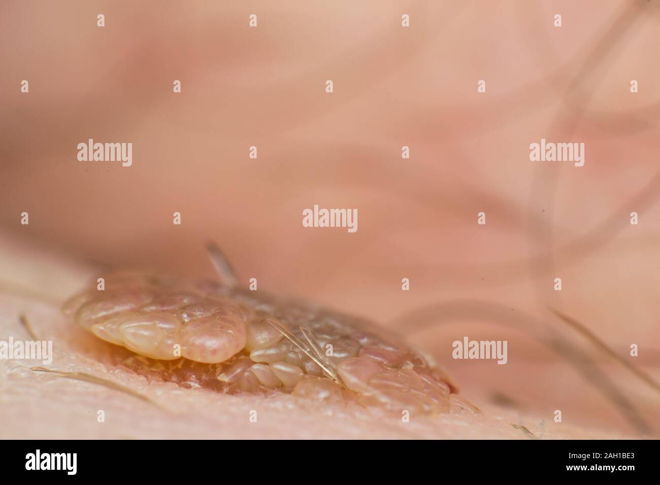Macro photo of a skin wart, papilloma virus infection Stock Photo - Alamy