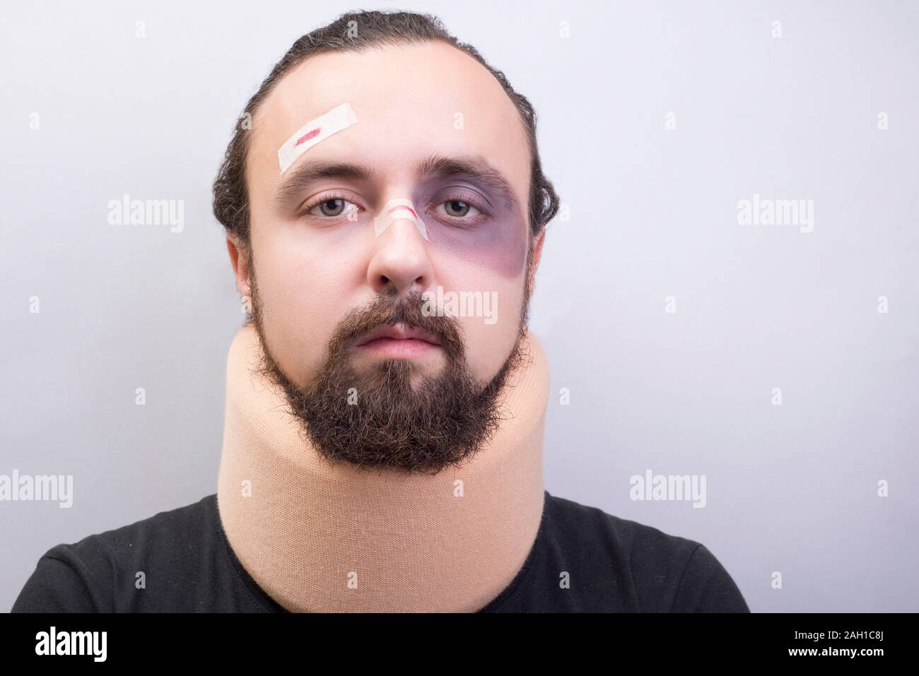 Closeup portrait of a young guy with bruises on his face, with a neck ...