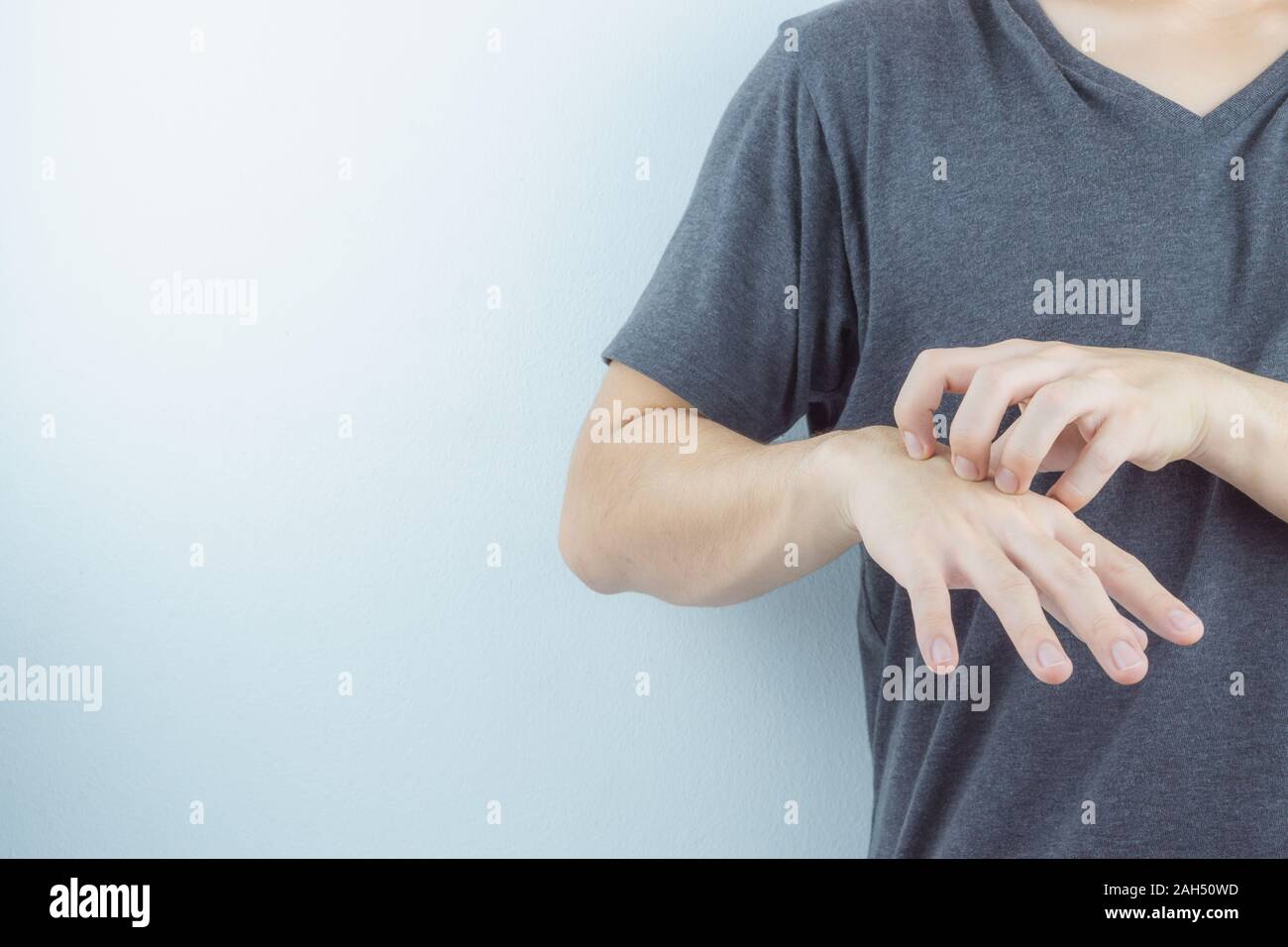 Close up man scratching his itchy hand with allergy rash by hand on ...