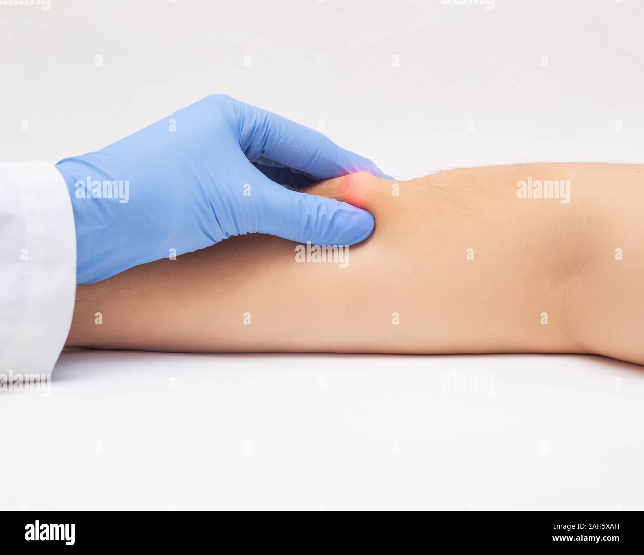 Doctor dermatologist examines the subcutaneous wen on the patient's arm ...