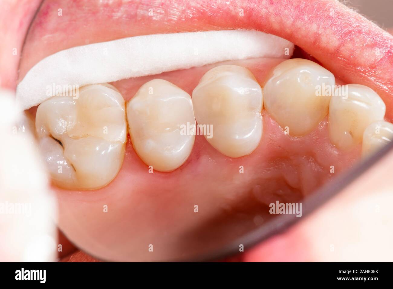 two chewing side teeth of the upper jaw after treatment of caries ...