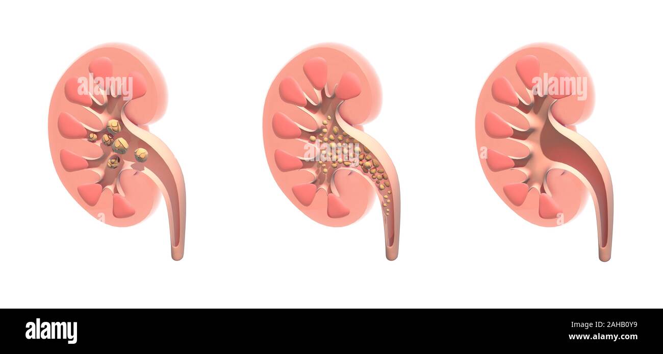 3D anatomical illustration of the inside of the kidney. Showing small ...