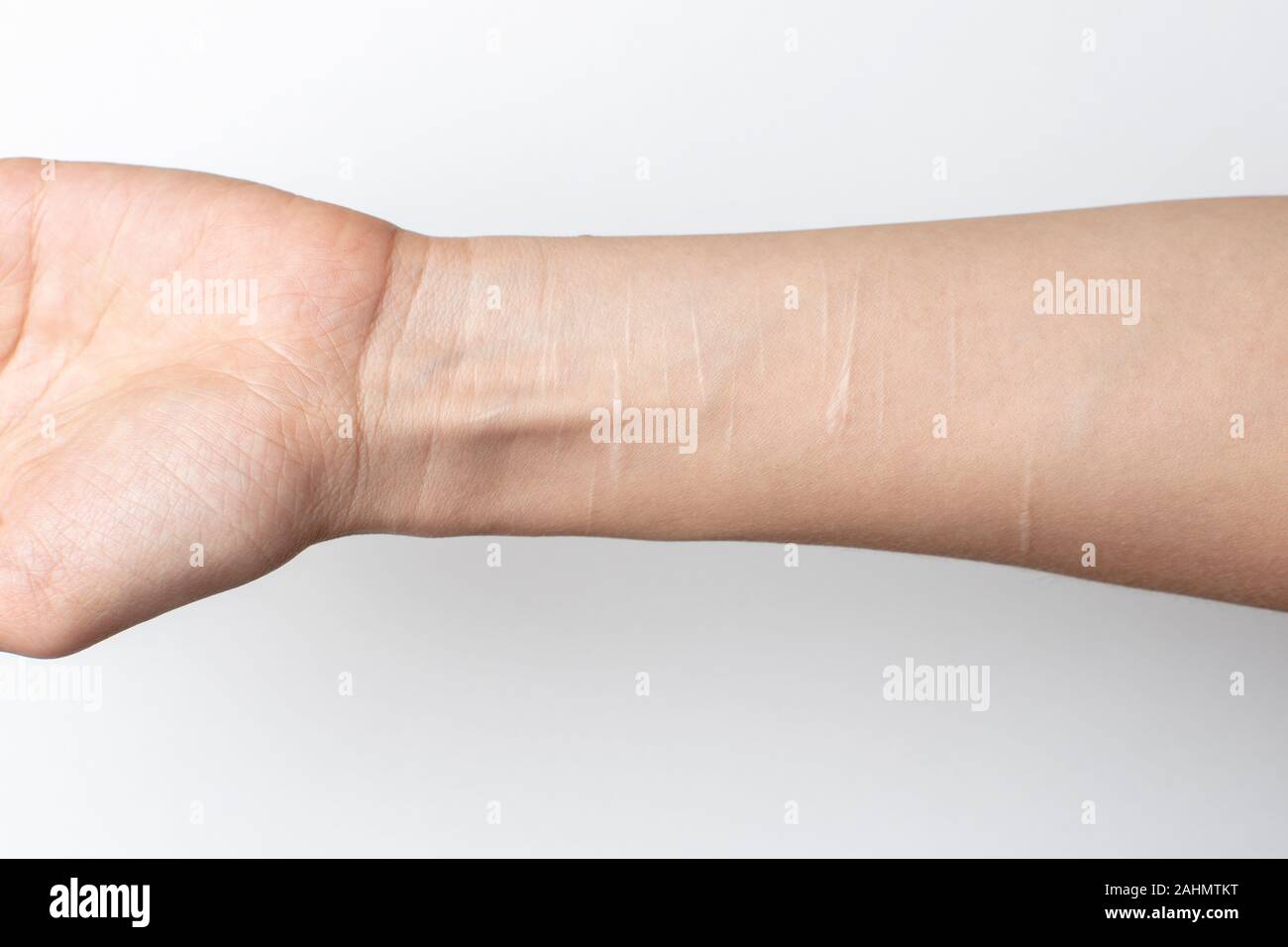 female hand close-up with scars from cuts by a blade Stock Photo - Alamy