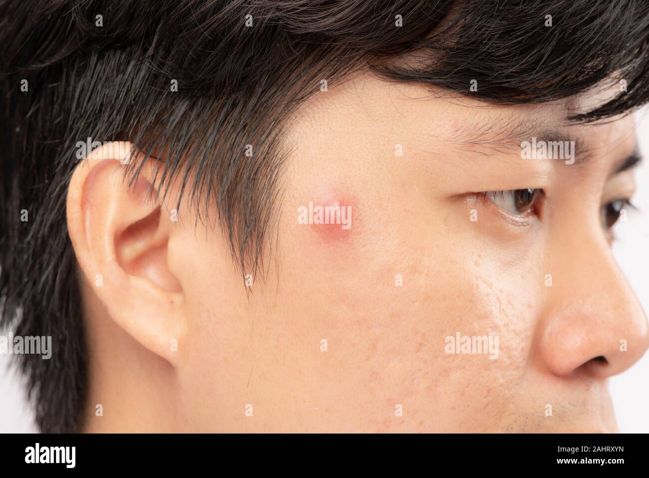 Close up photo of acne prone skin, a man squeezing his pimple Stock ...