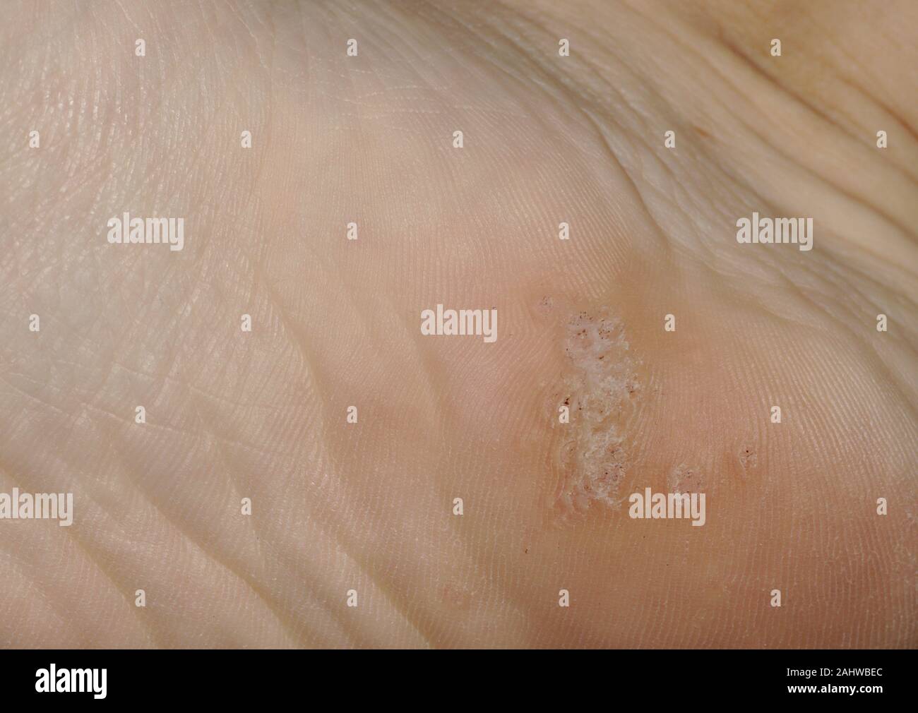 Wart close up hpv hi-res stock photography and images - Alamy