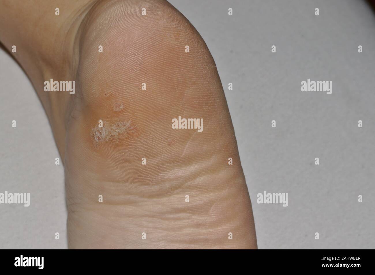 Human heel anatomy hi-res stock photography and images - Alamy