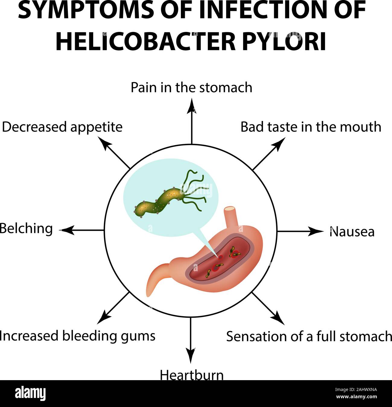 Symptoms of infection of Helicobacter pylori. Infographics. Vector ...