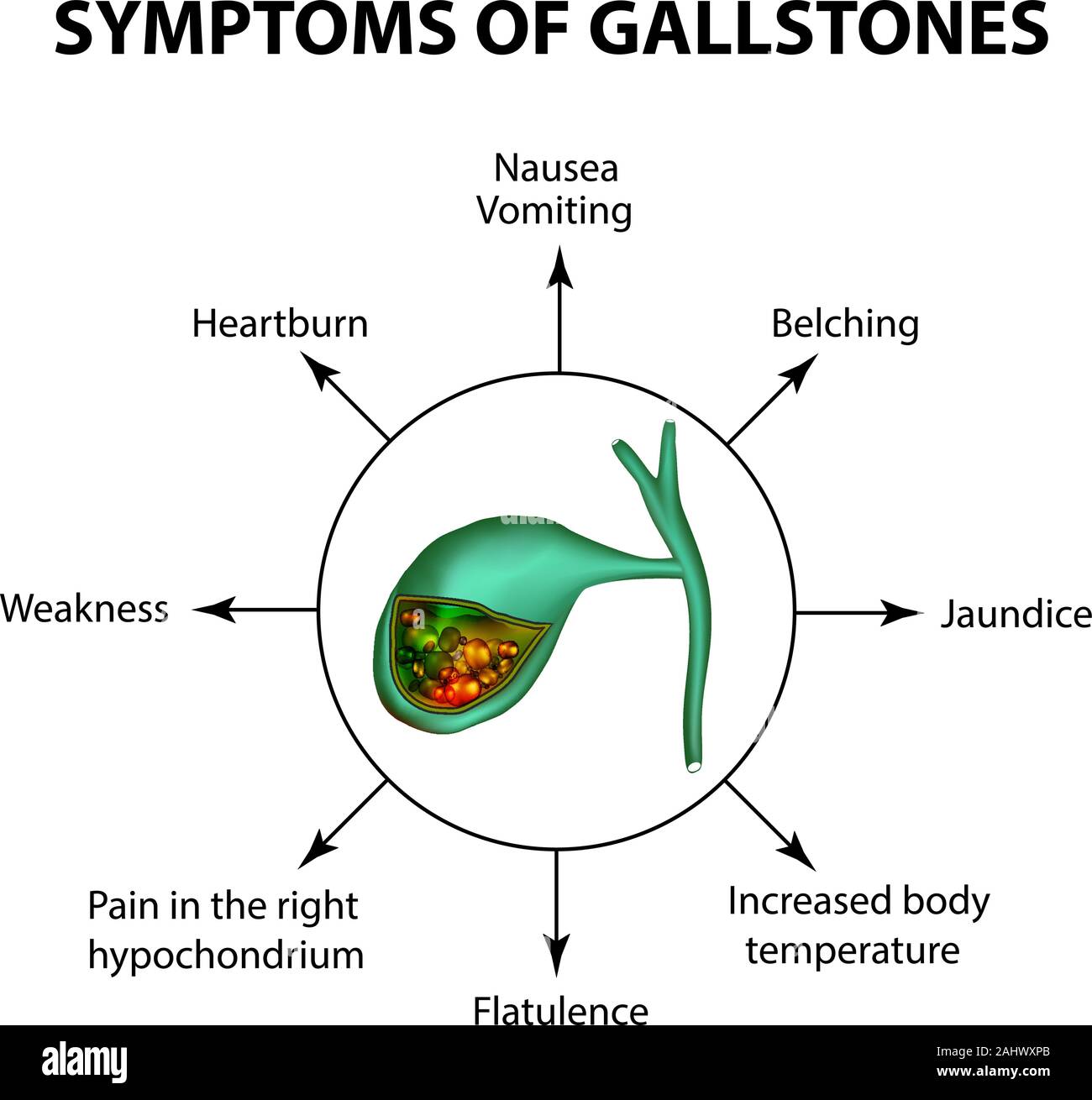 Symptoms of stones in the gallbladder. Infographics. Vector ...
