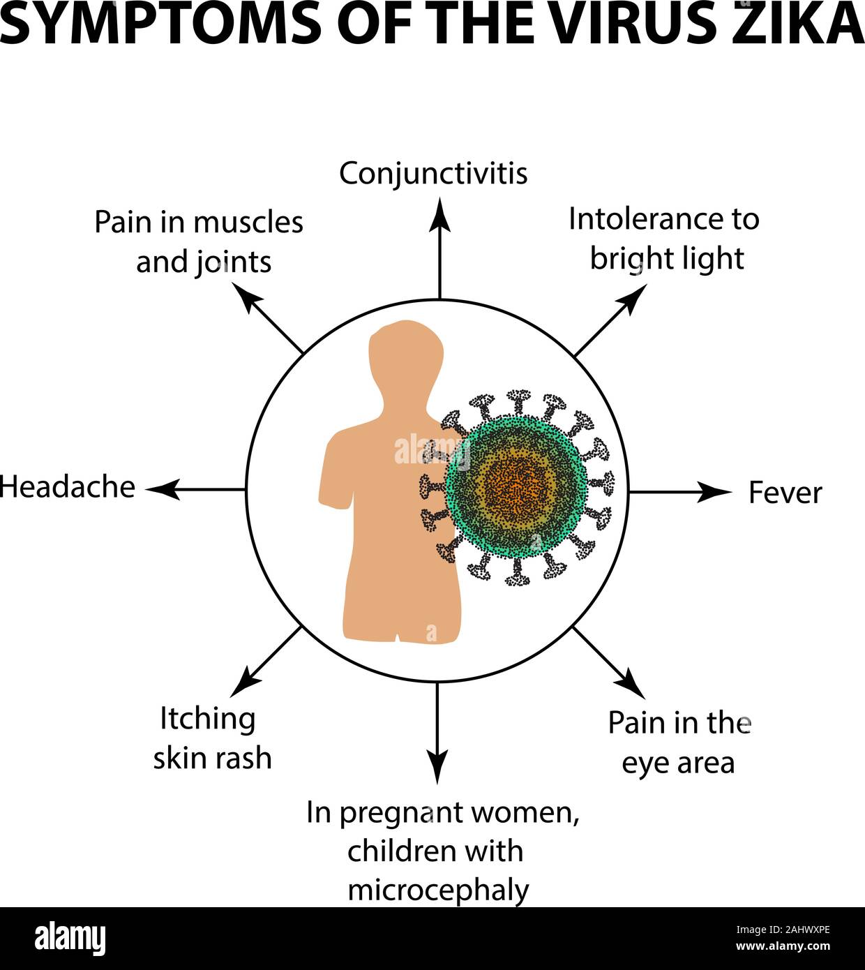 Symptoms of the virus Zika. Infographics. Vector illustration on ...