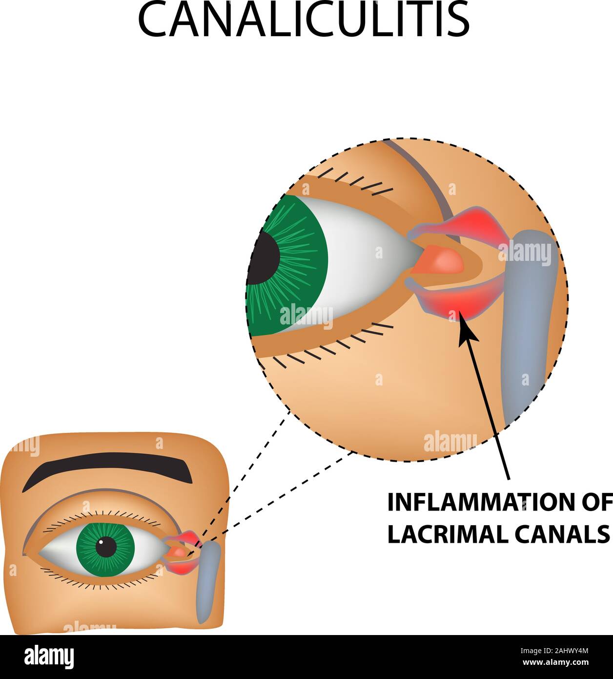Canaliculitis. Inflammation of lacrimal canals. The structure of the ...
