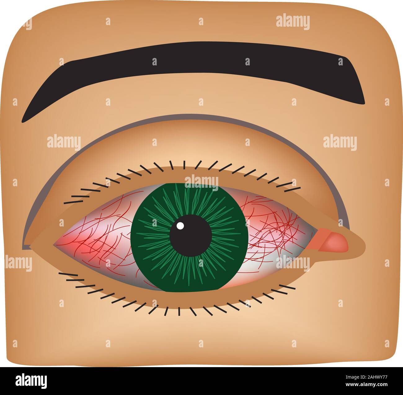 Conjunctivitis. Redness and inflammation of the eye. Vessels in the eye ...
