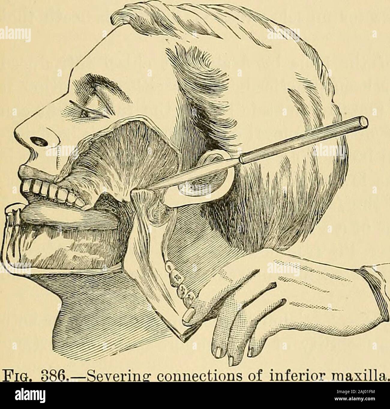 Operative surgery . re-moval of the entire jaw onedied. It will be seen ...