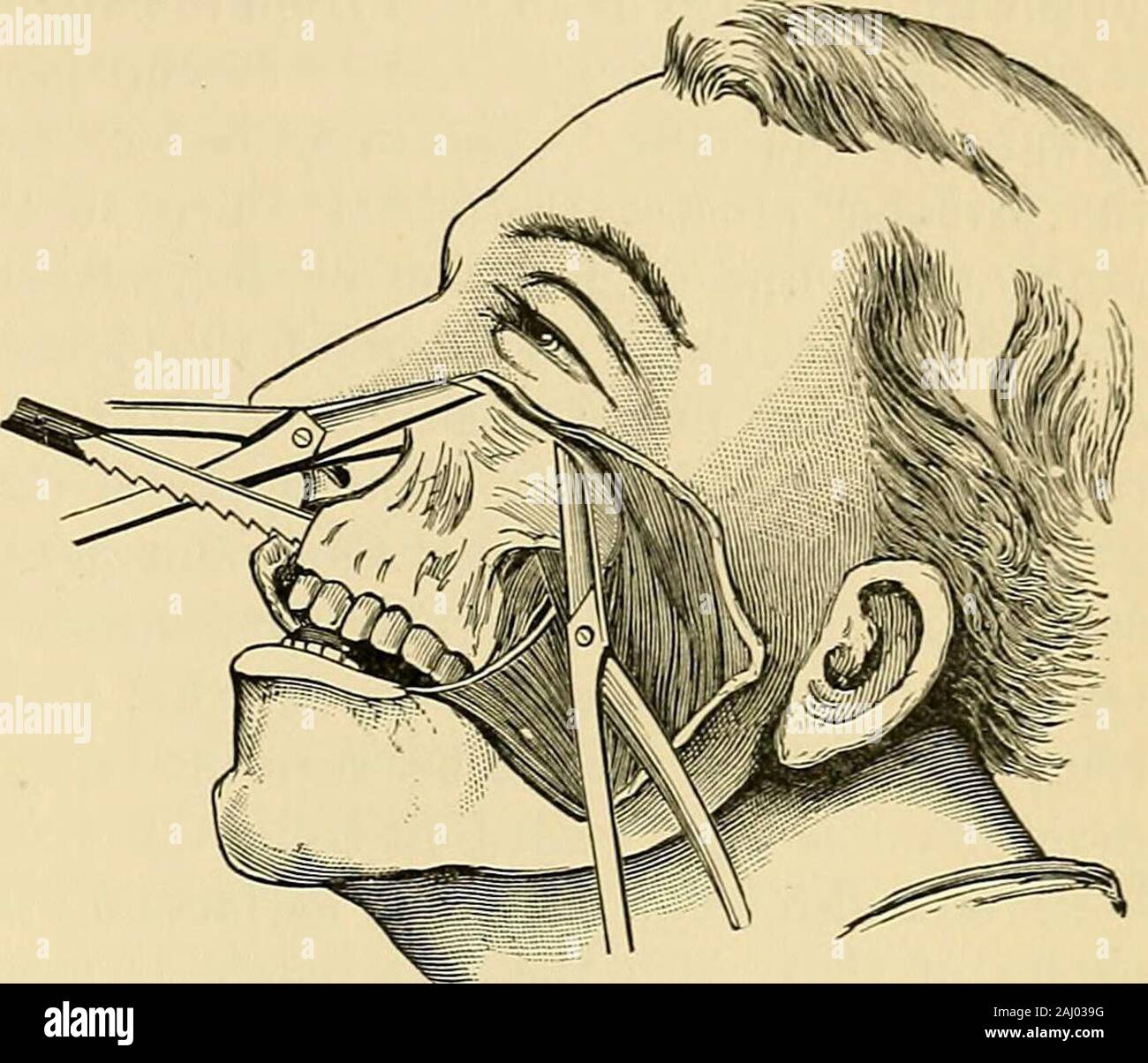 Operative surgery . FiG. 380.—Lines of incision in removal ofupper jaw ...
