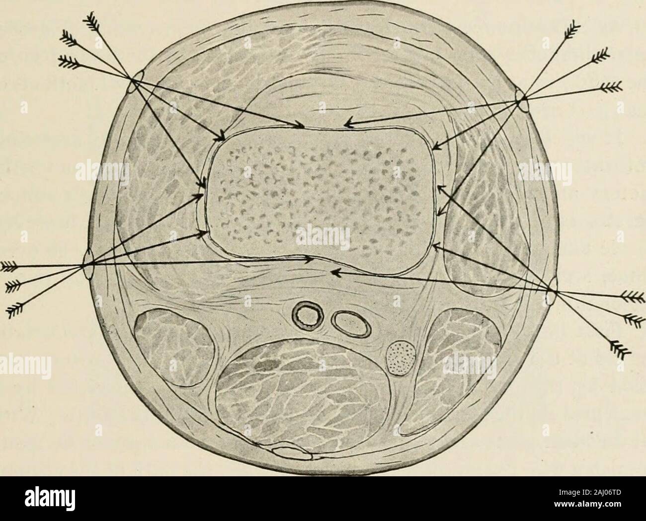 Infiltration anesthesia hi-res stock photography and images - Alamy