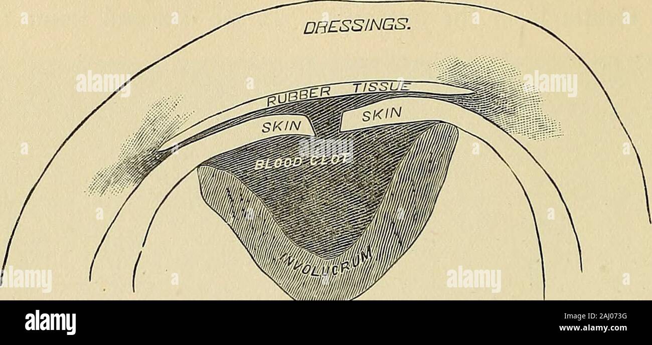 Operative surgery . Fig. 370.—Instruments employed in gouging.a, b ...