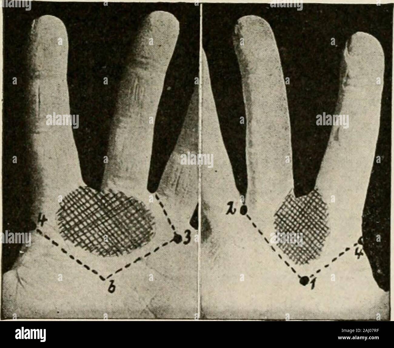 Local and regional anesthesia; with chapters on spinal, epidural ...