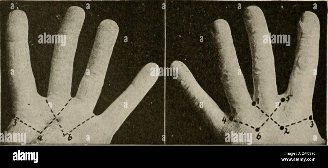 Infiltration anesthesia hi-res stock photography and images - Alamy