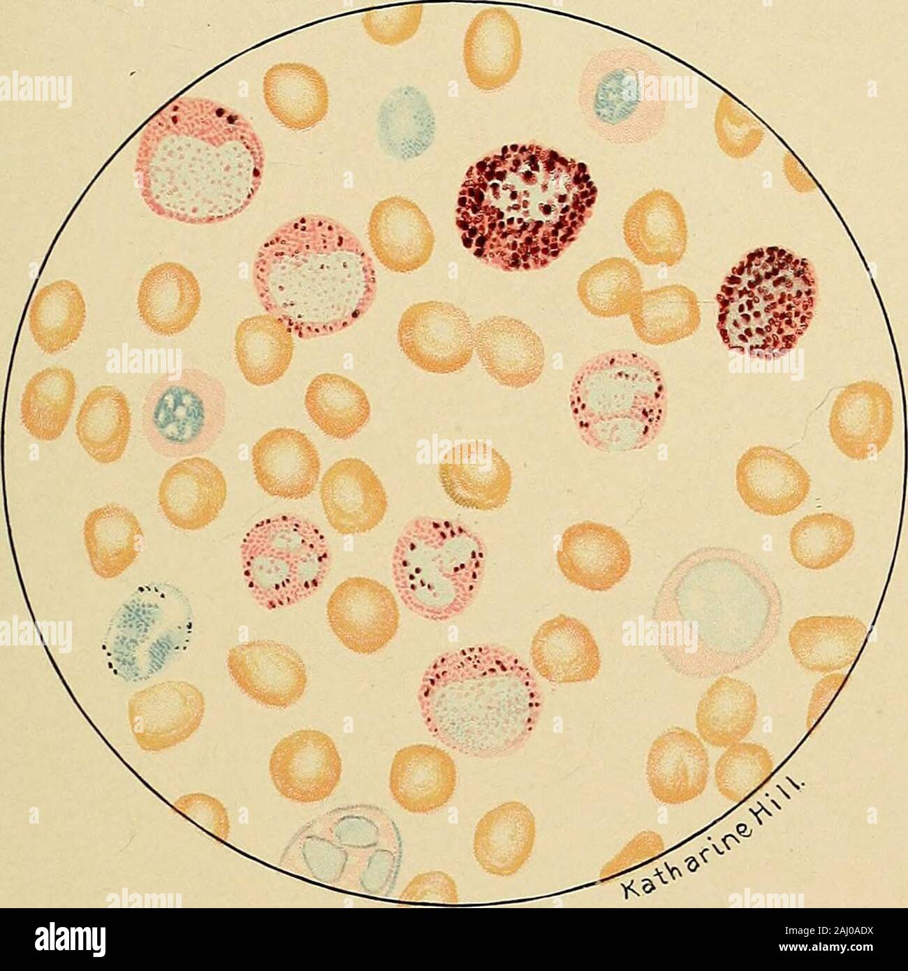Leukemia Cells Differential