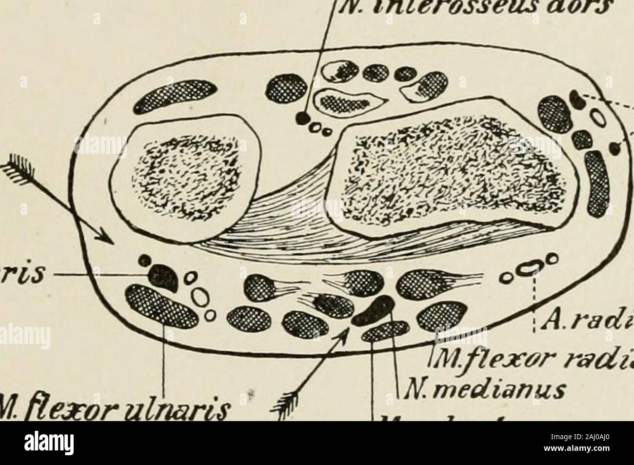 Local and regional anesthesia; with chapters on spinal, epidural ...