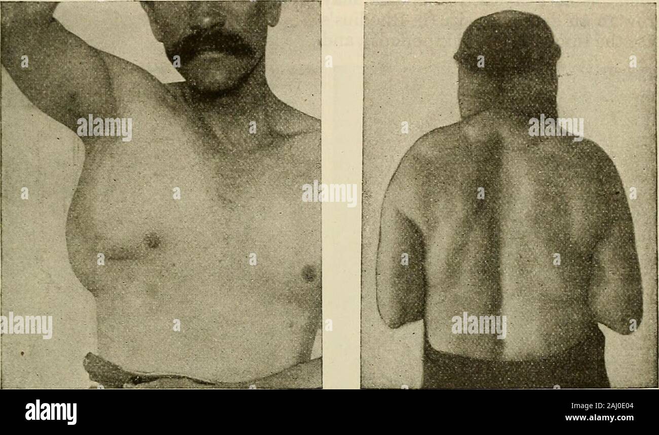 Hyperplasia hypertrophy hi-res stock photography and images - Alamy