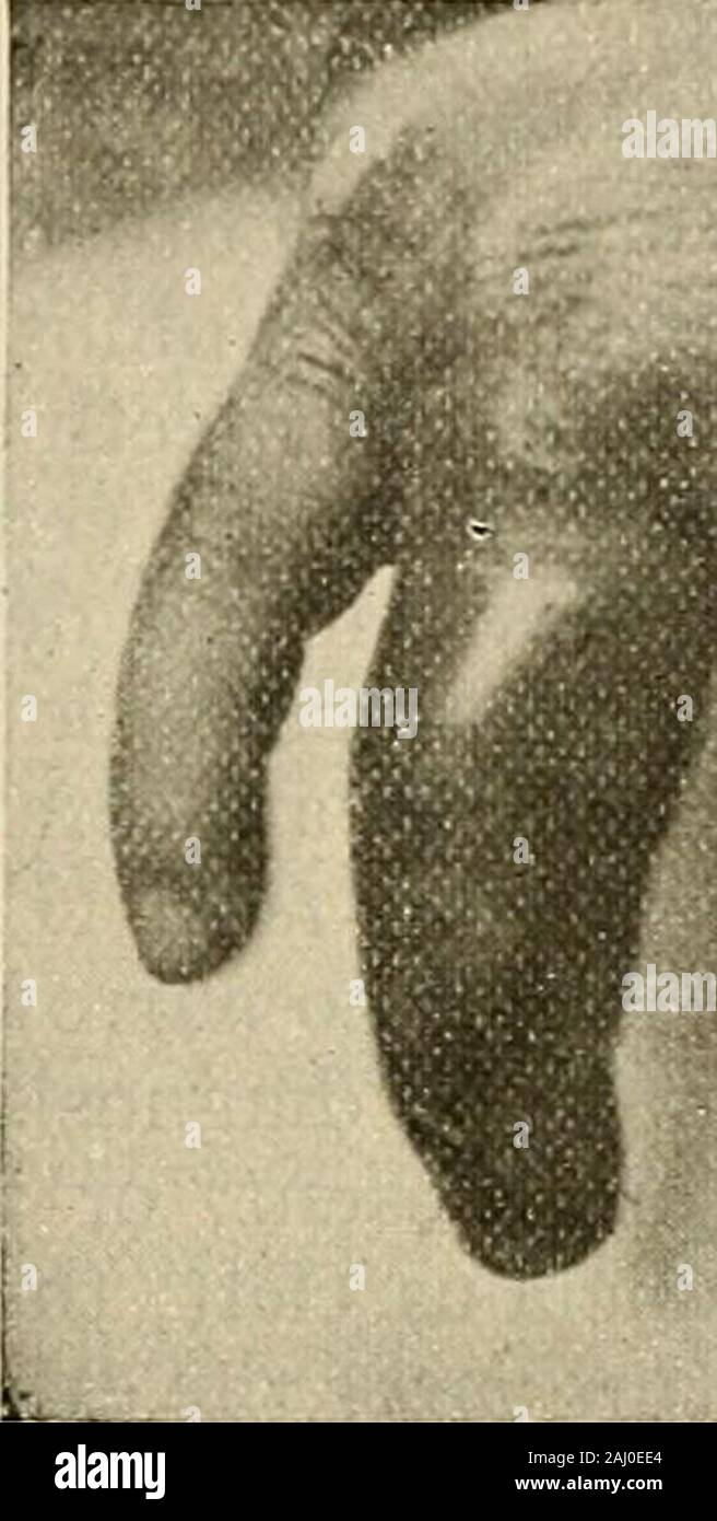 Gummatous syphilis hi-res stock photography and images - Alamy