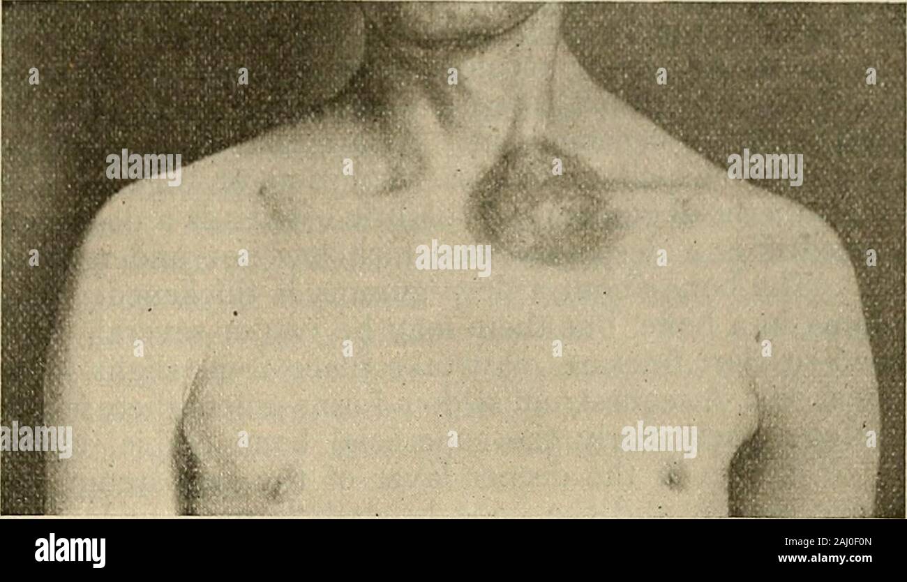 Tertiary syphilis hi-res stock photography and images - Alamy