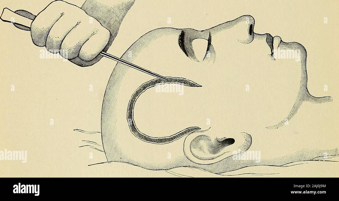 Operative surgery . Pig. 319.—Making the bone flap. frequently very ...