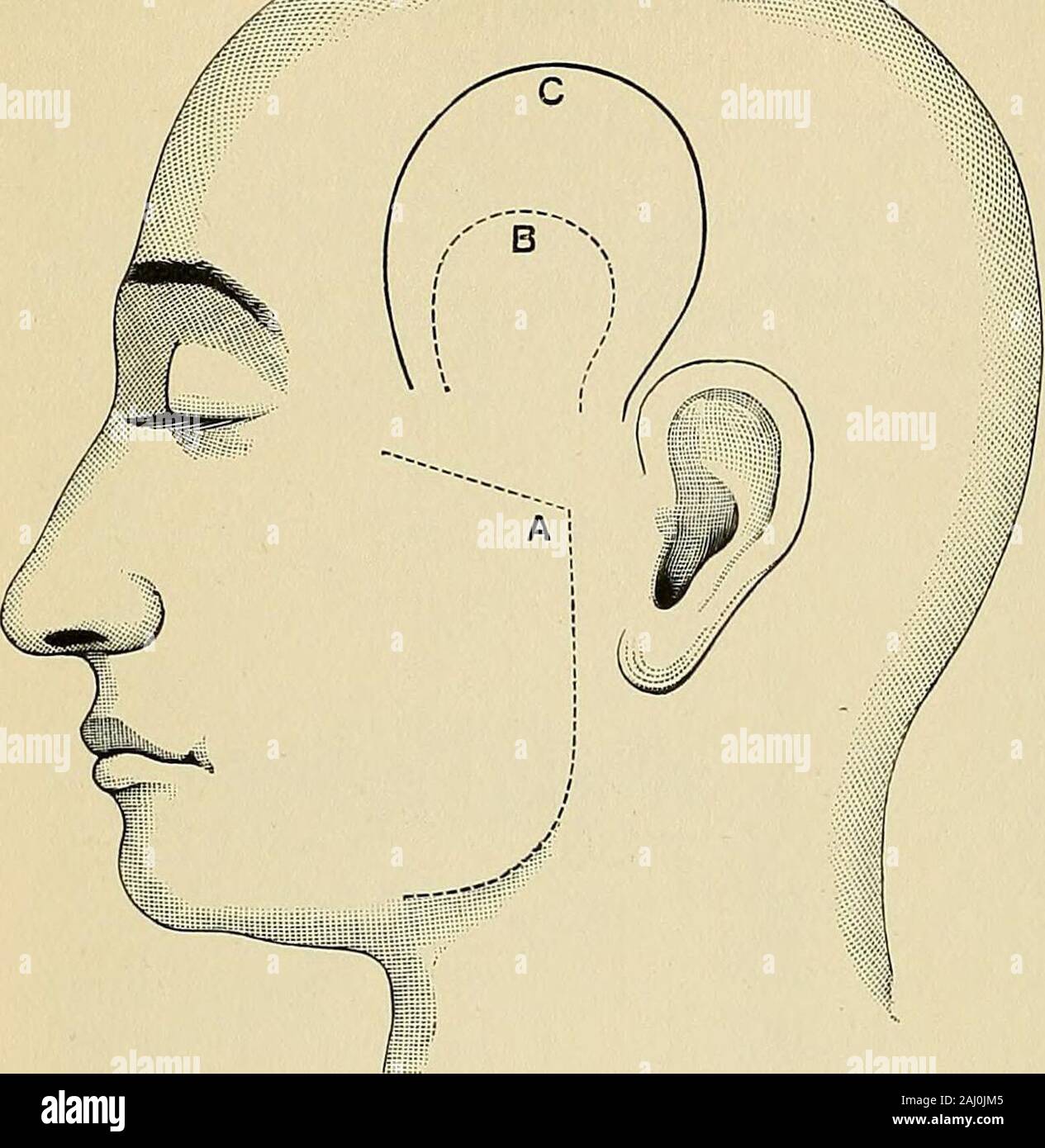 Transverse bone fracture hi-res stock photography and images - Alamy