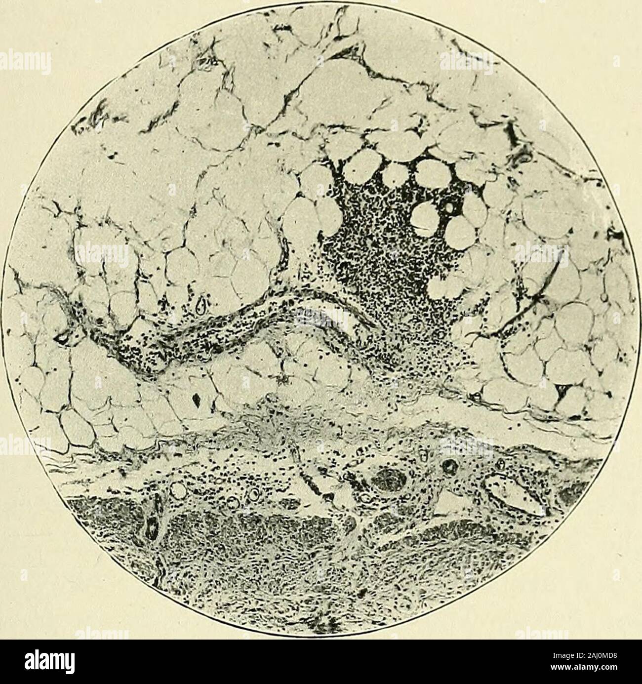 Appendicitis : its pathology and surgery . nterlocking sutures, and to ...