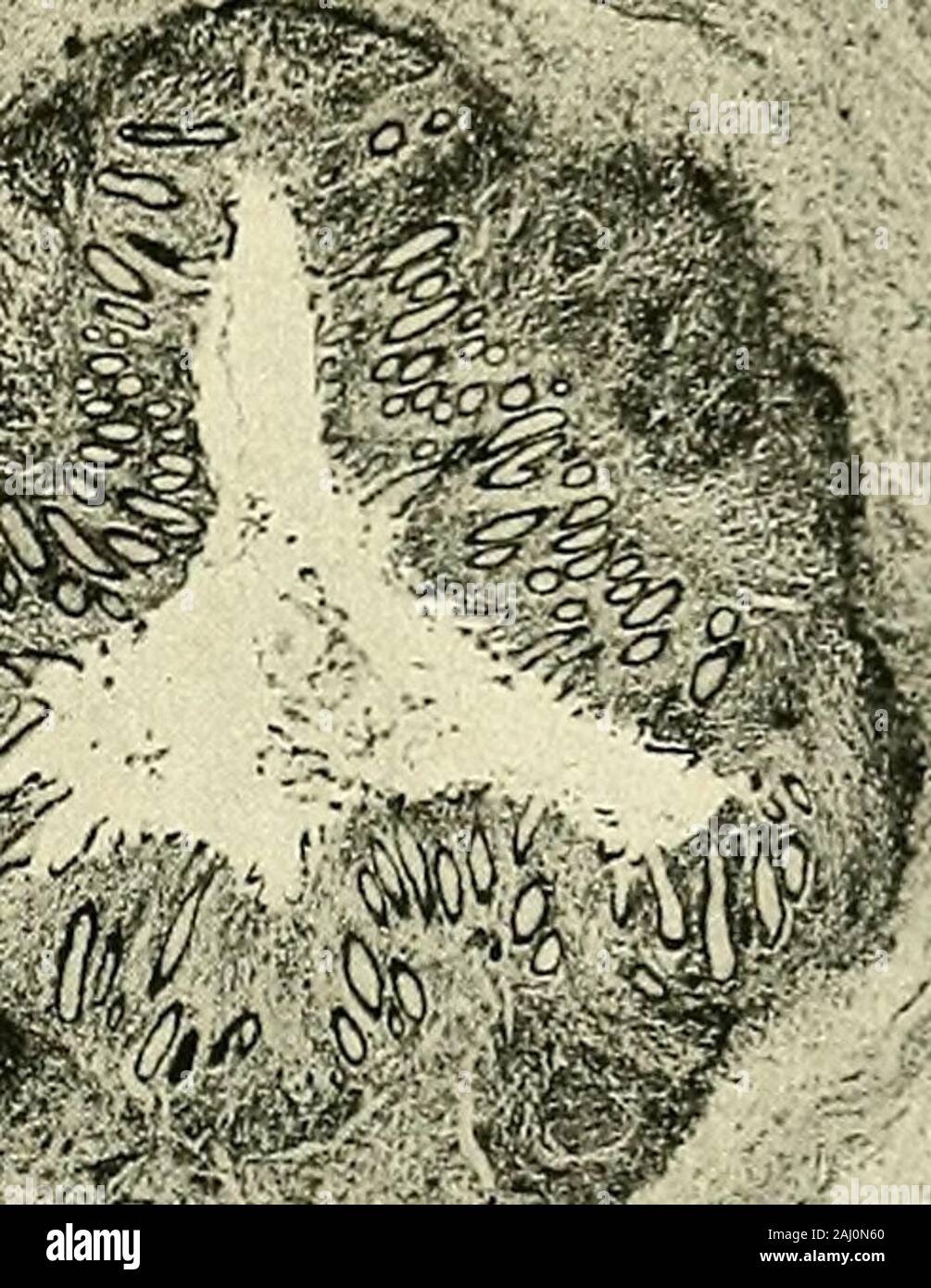 Appendicitis : its pathology and surgery . Fig. 47.—Appendicitis with a ...