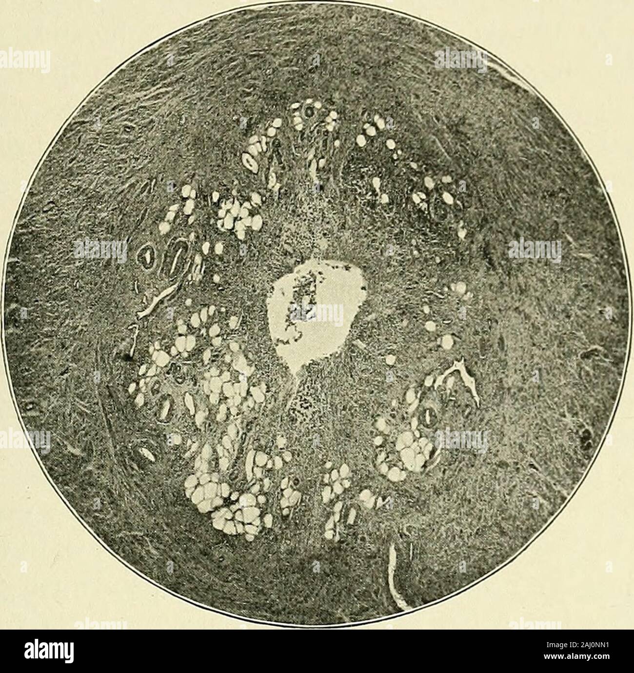 Appendicitis : its pathology and surgery . ar glands and someof the ...