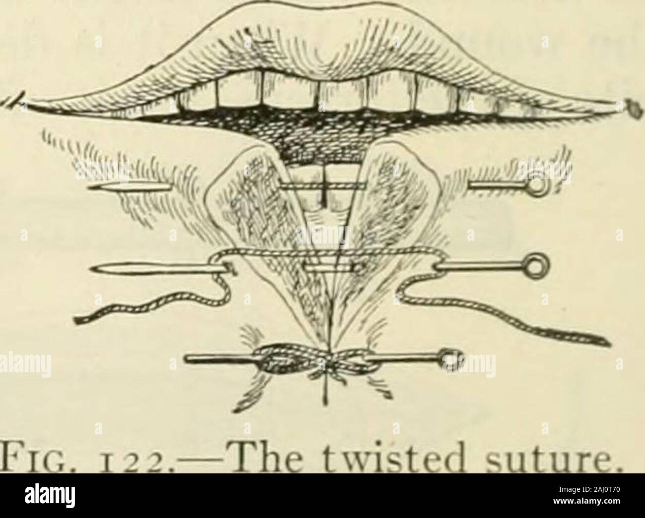 Avulsion wound hi-res stock photography and images - Alamy