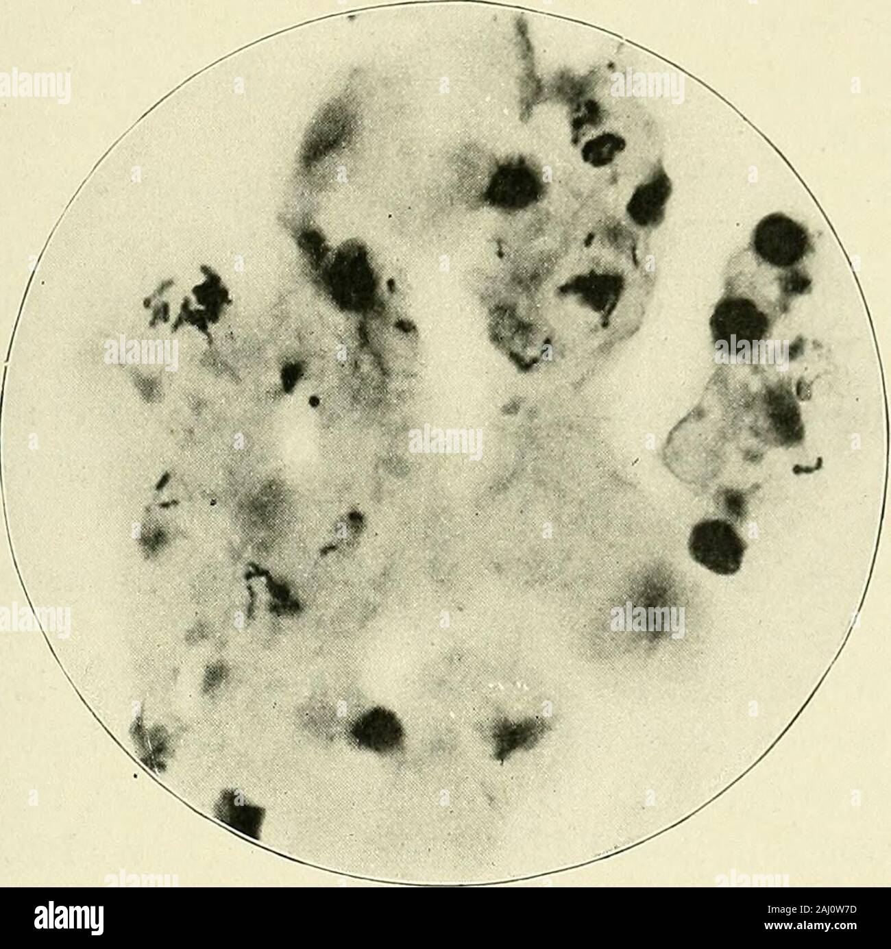 Appendicitis : its pathology and surgery . membrane are gone. A small ...