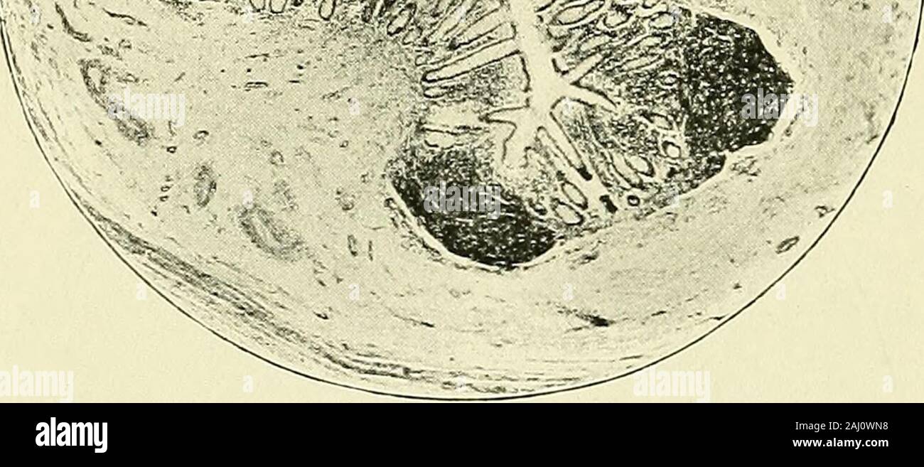 Appendicitis : its pathology and surgery . Fig. 31. —The appendix ...